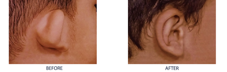 Otoplasty